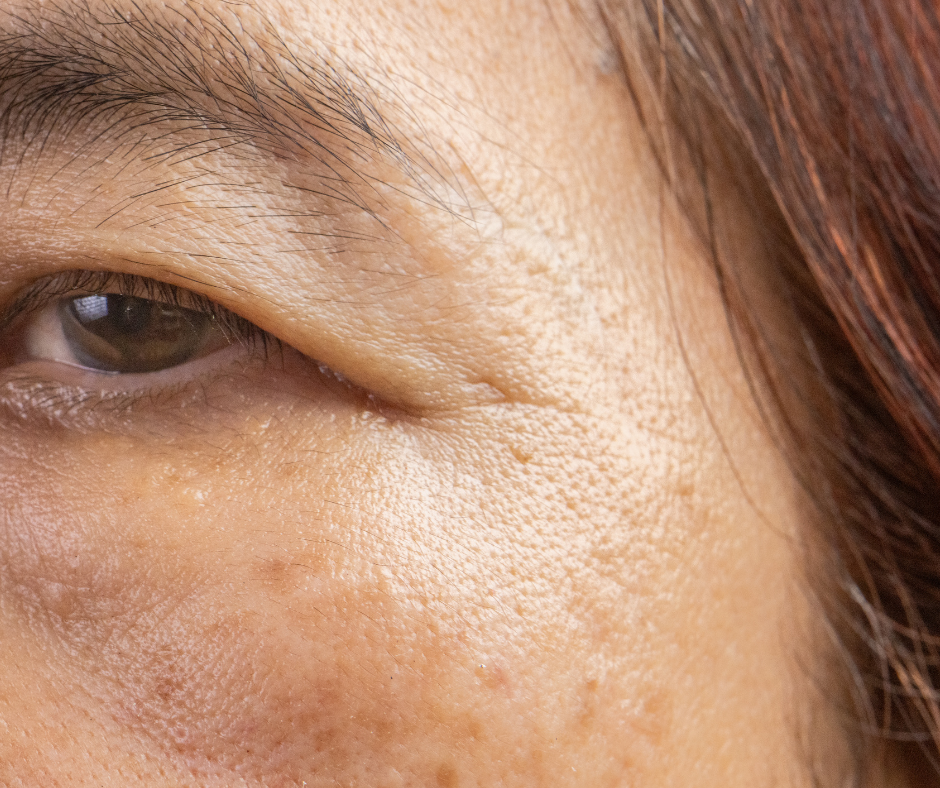 Age Spots: Effective Treatments for Senior Skin - Living Well for Seniors